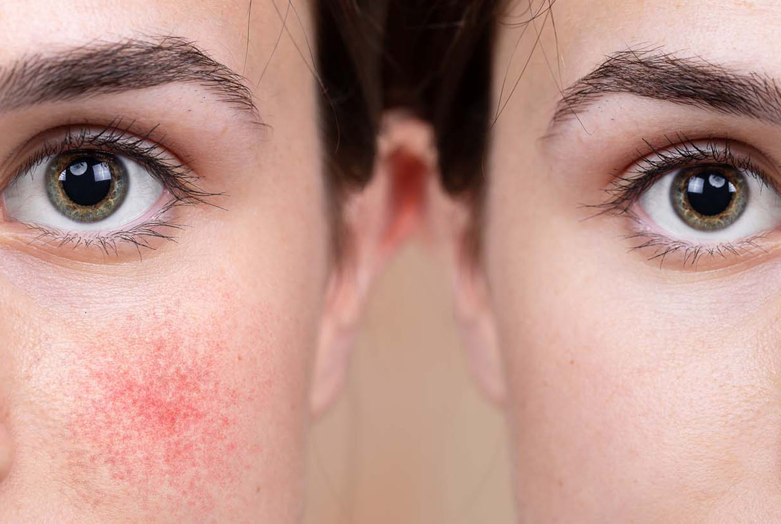 Rosacea Laser Treatment Dallas & Plano, TX | Aesthetician Nasrin